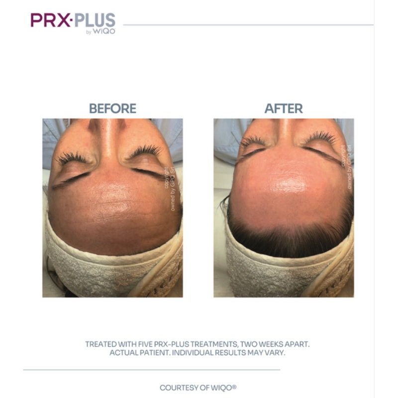 PRX Plus Face & Neck (5) 18 Year Anniversary Special (SAVE $930) – Hall ...